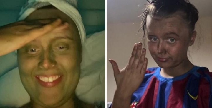 Tertidur Di Bawah Sinar Matahari Selama 30 Menit, Dahi Wanita Ini ...